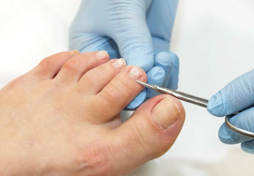 Navigating Toenail Trauma: Types, Treatment, and Prevention - Centers ...