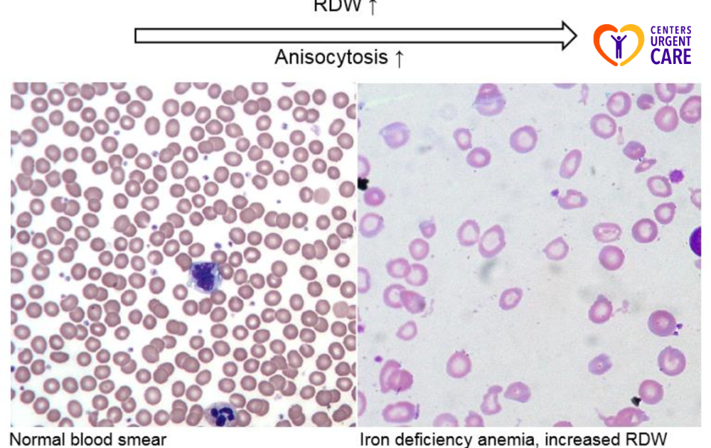 Step-by-Step Guide to Blood Smearing - Centers Urgent Care