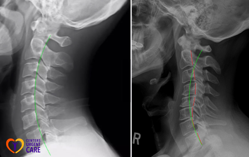 The Importance of Cervical Spine X-Rays - Centers Urgent Care