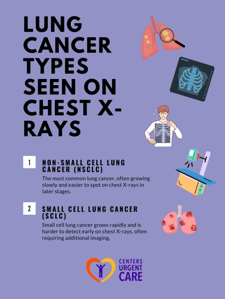 Can Chest X-Rays Show Lung Cancer? What You Should Know - Centers ...