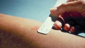 PPD Test Accuracy: What You Should Know - Centers Urgent Care