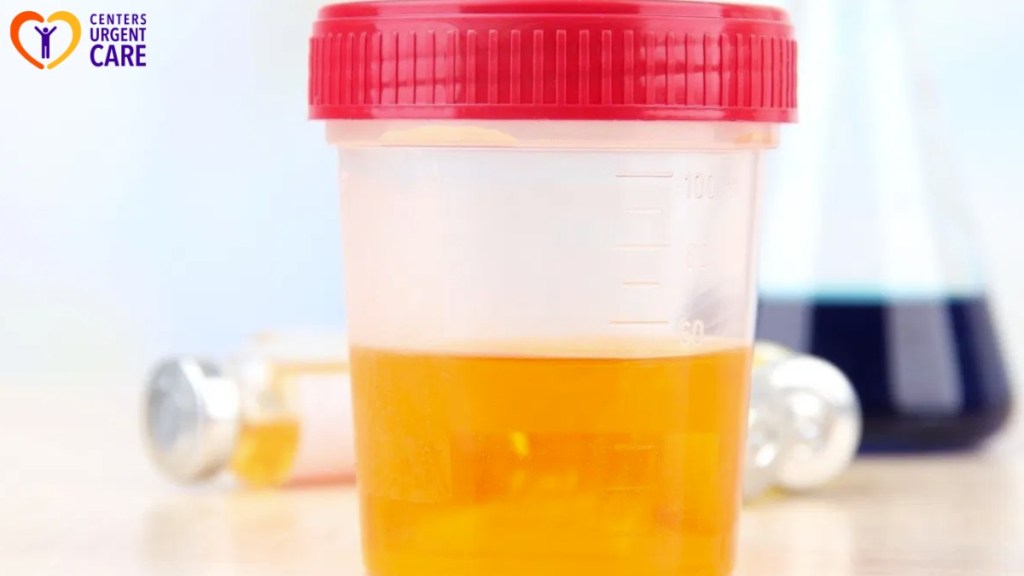 Is Urobilinogen in Urine Normal? Find Out Here - Centers Urgent Care