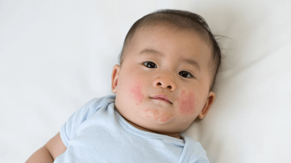 What Causes Eczema in Children? Key Triggers Explained - Centers Urgent ...