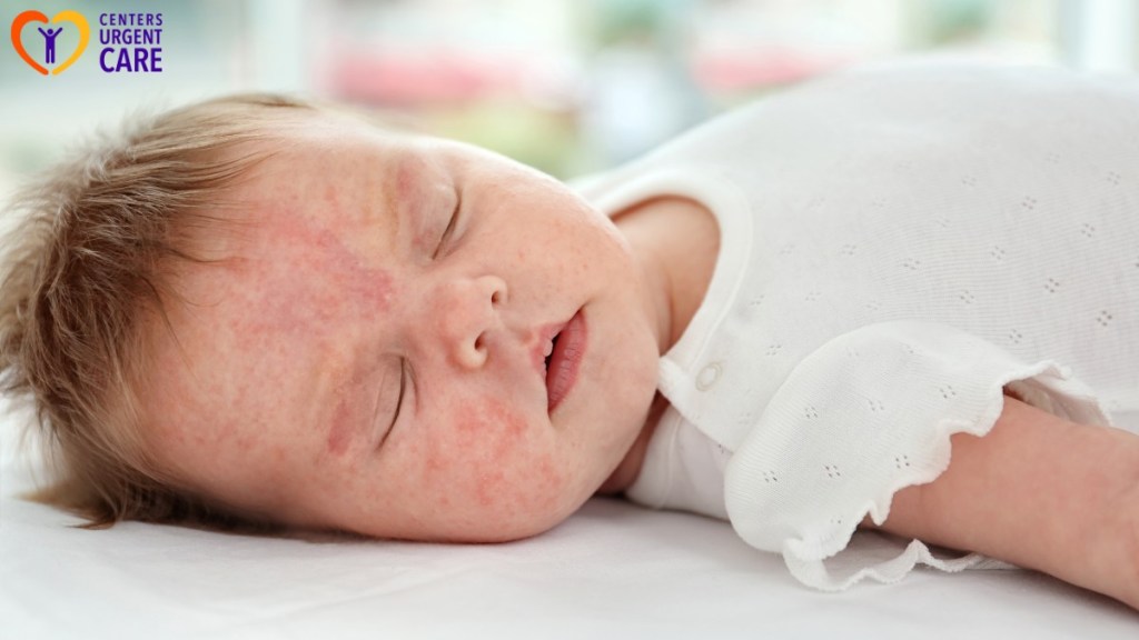 What Causes Eczema in Children? Key Triggers Explained - Centers Urgent ...