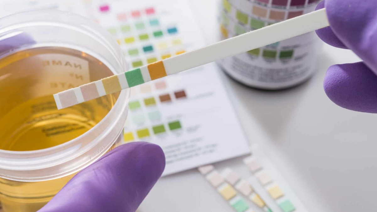 What is Tested in a DOT Physical Urine Examination - Centers Urgent Care