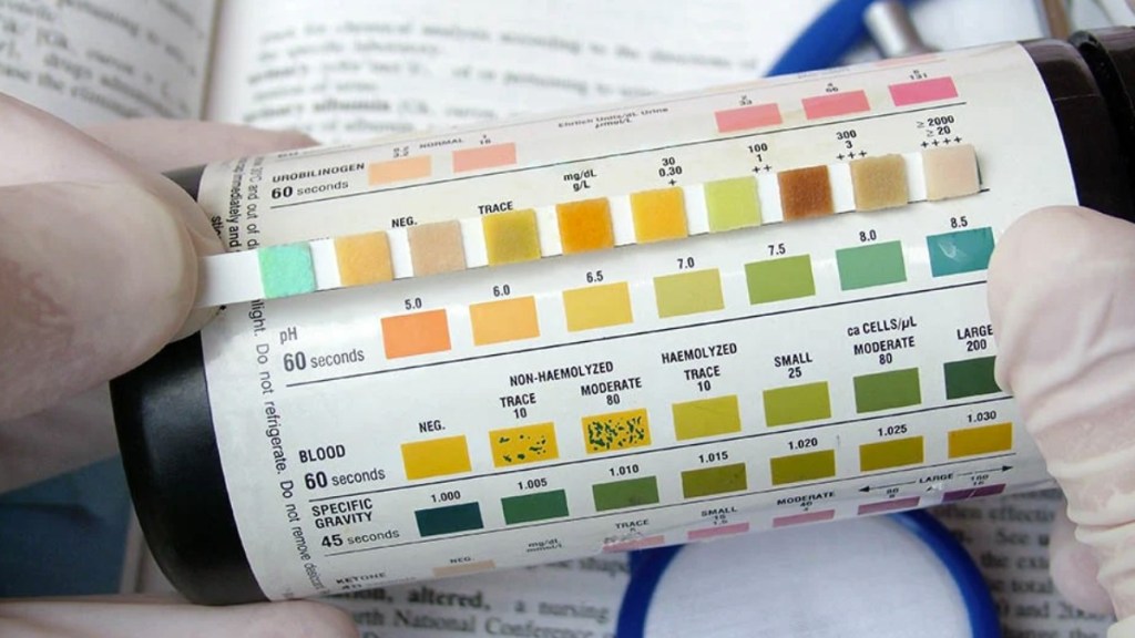 Understanding the Reagent Strip Test for Urine: A Guide - Centers ...