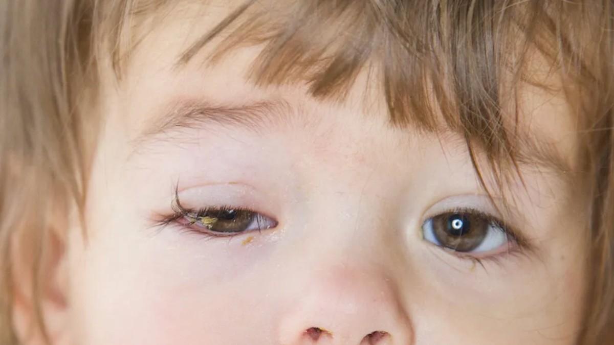 Pink Eye in Toddlers? Here’s How to Treat It Quickly and Safely ...