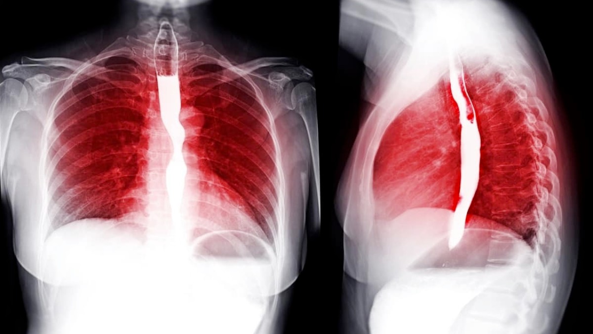Contrast X-Rays for GI Imaging – How They Spot the Problem - Centers ...