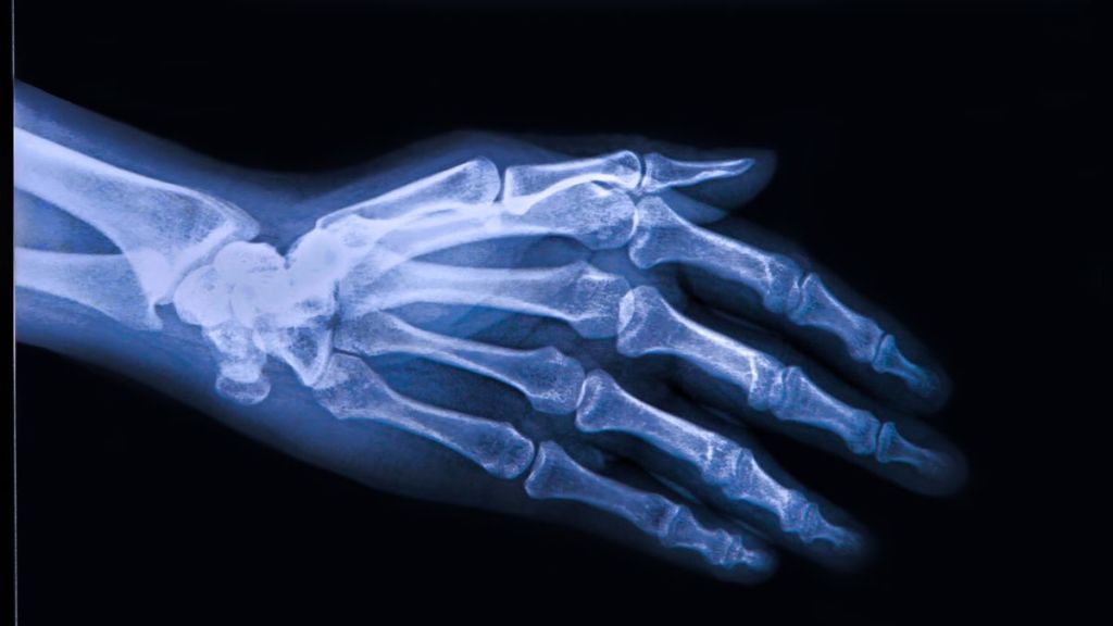 Wellness Tips from Josef Schenker, MD | Finger Dislocation First Aid ...